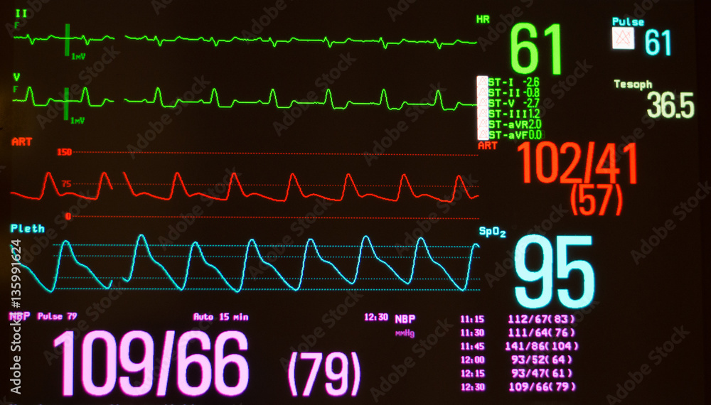Monitor with black screen showing Intraventricular Conduction Delay on ...