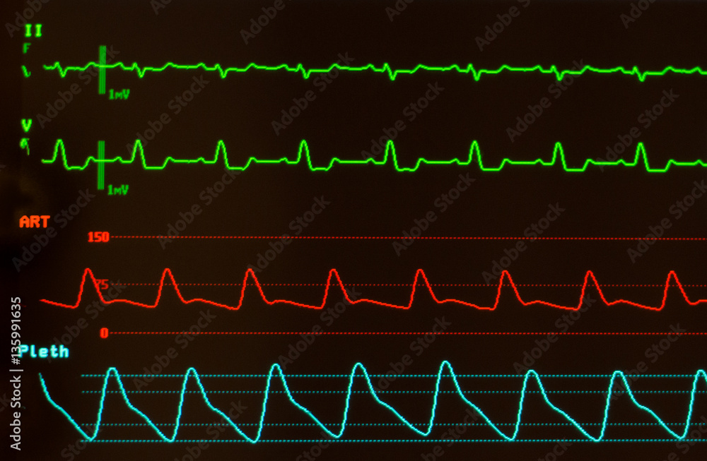 Close up of monitor with black screen showing Intraventricular ...