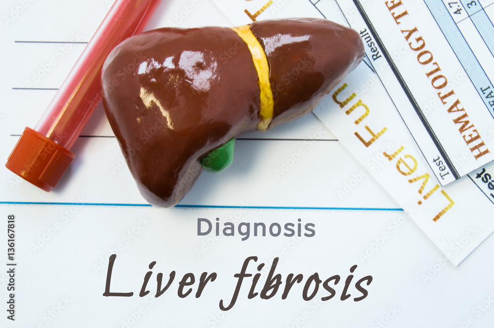 Fotografia do Stock: Liver fibrosis diagnosis. Sheet of paper or book ...