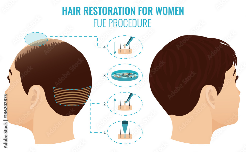 Female Hair Loss Treatment With Follicular Unit Extraction Stages Of