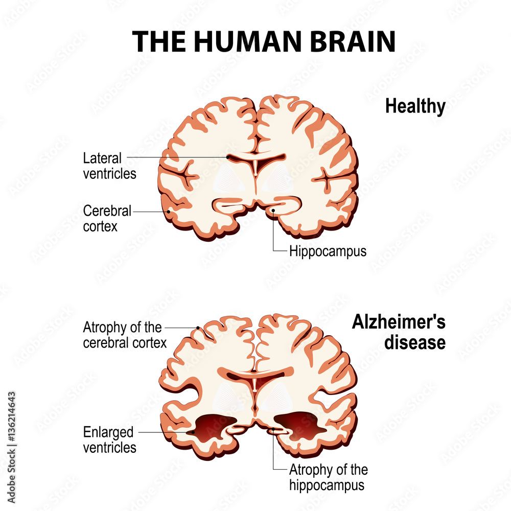 Cross-section of the human brain with Alzheimer's disease Stock Vector | Adobe Stock