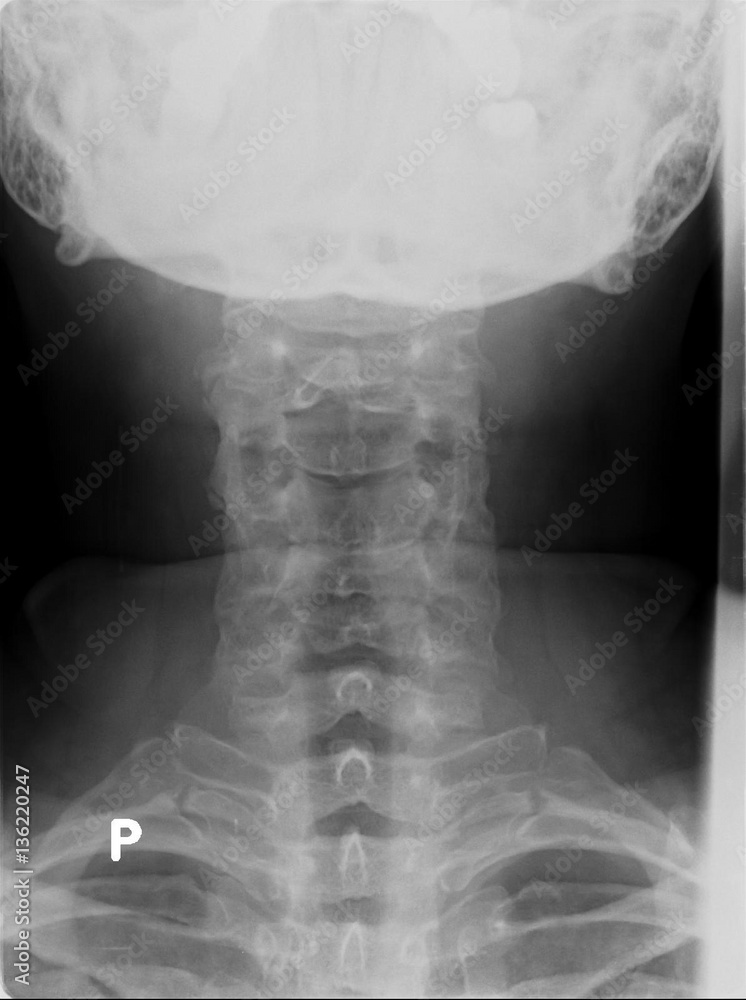 X-Ray or MRI - Magnetic Resonance Imaging of Spinal Column and Skull ...