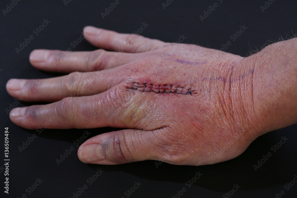 Suture wound on hand from dermatology procedure Stock Photo | Adobe Stock