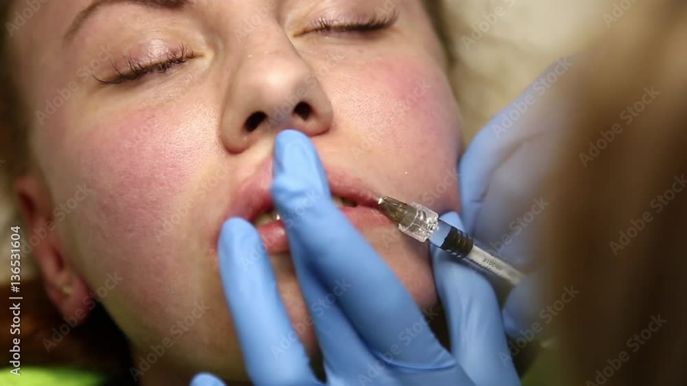 Vídeo do Stock: Young woman on lip Augmentation in a clinic. Anesthetic ...