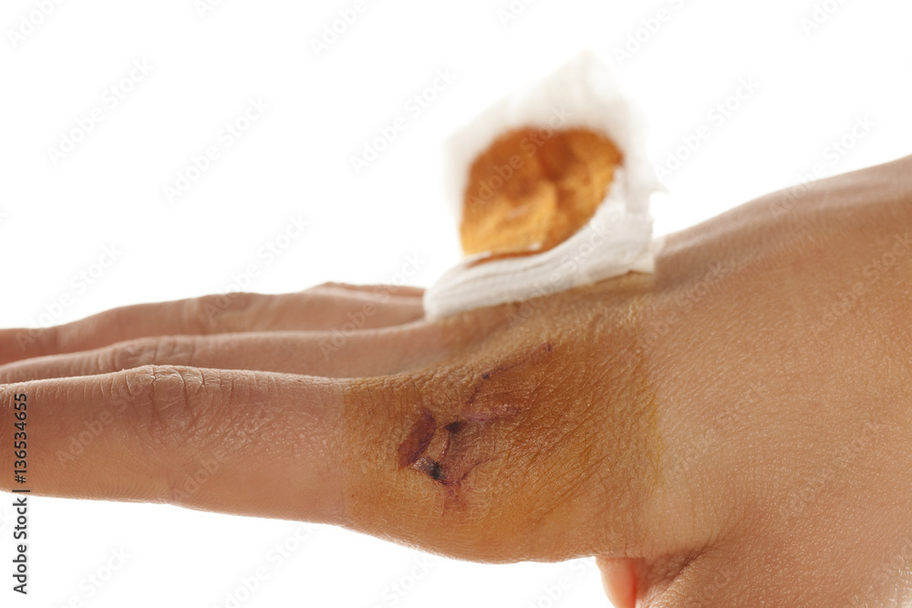 female injured hand with a lifted bandage Stock Photo | Adobe Stock