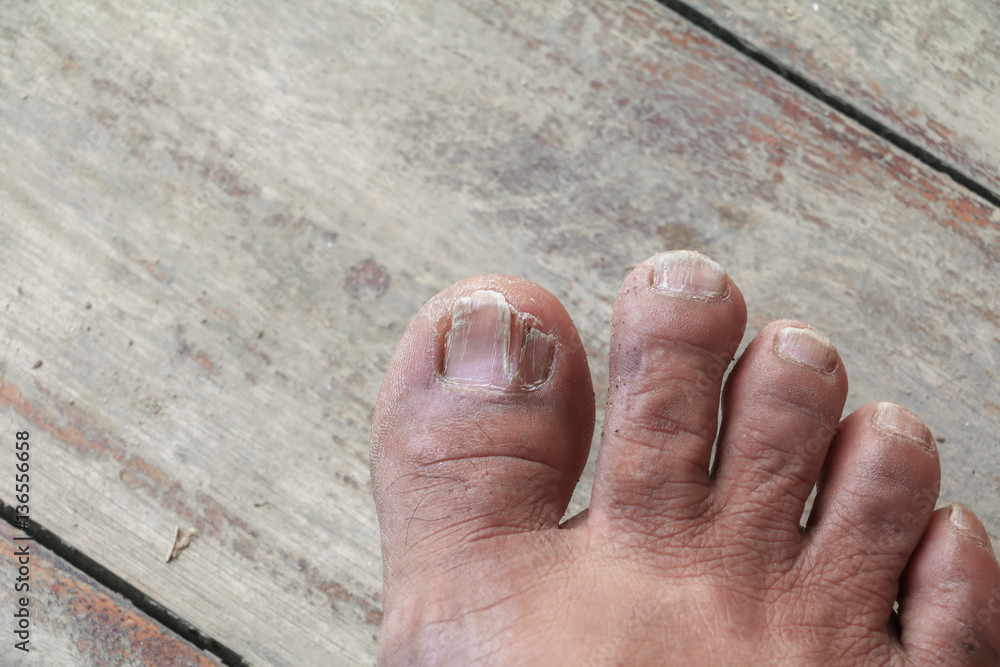 Broken Toenail