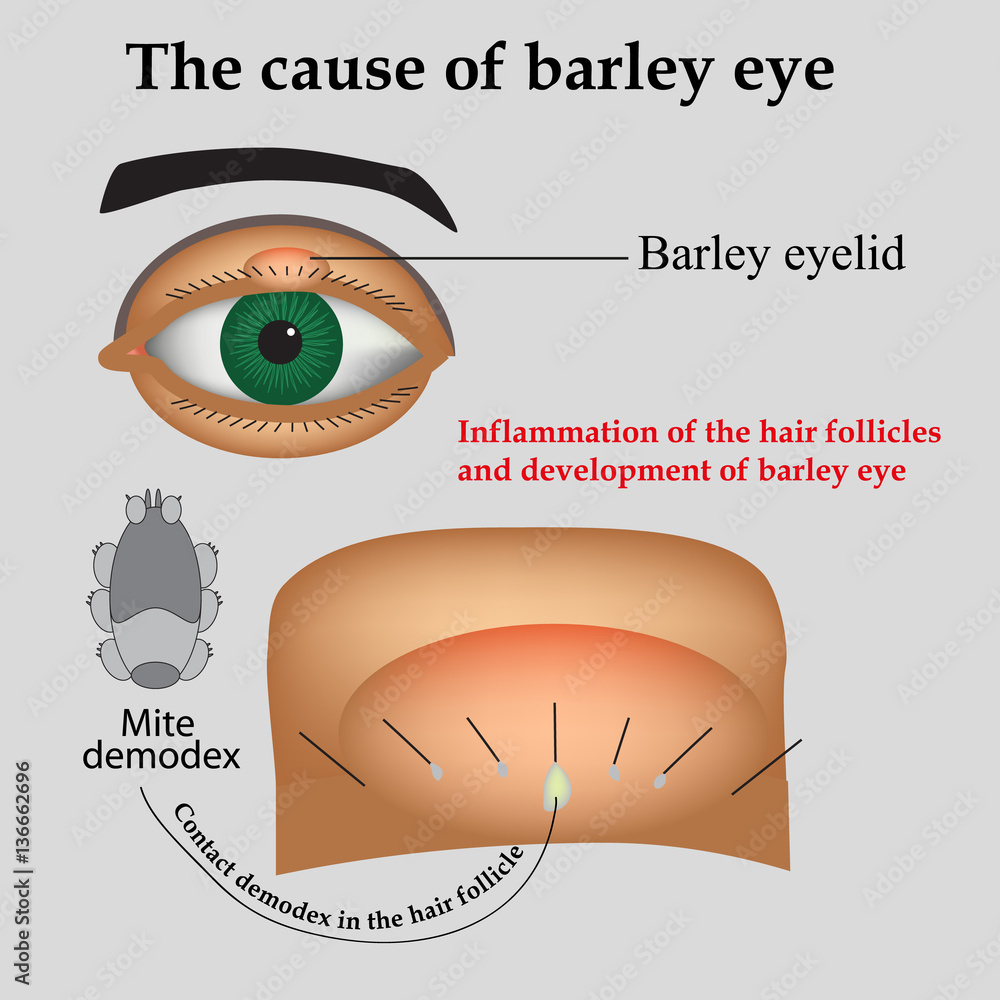 Diseases of the eye barley. Causes of barley. Demodex mite infestations ...