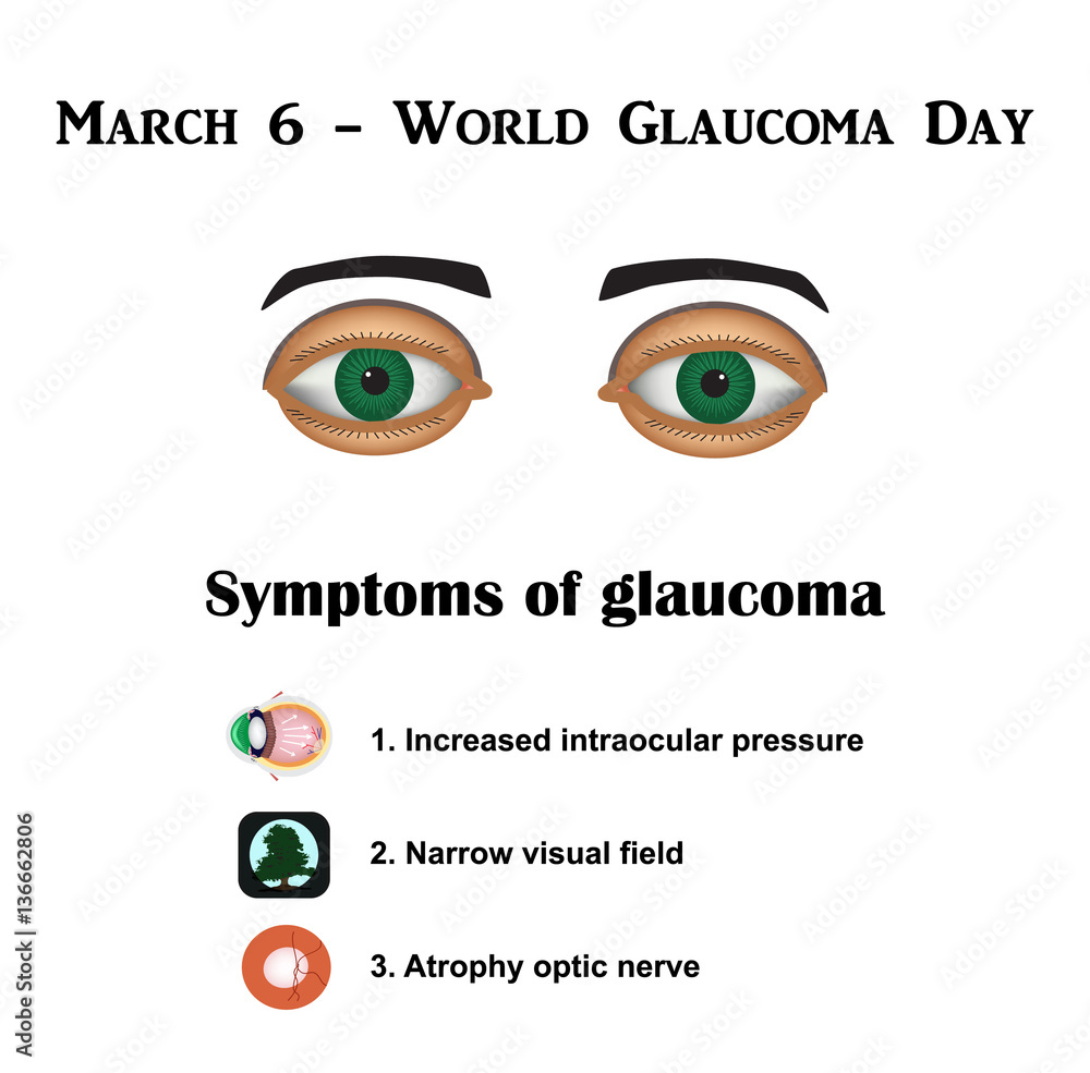 Glaucoma. Symptoms of glaucoma. Atrophy of the optic nerve. Field of ...