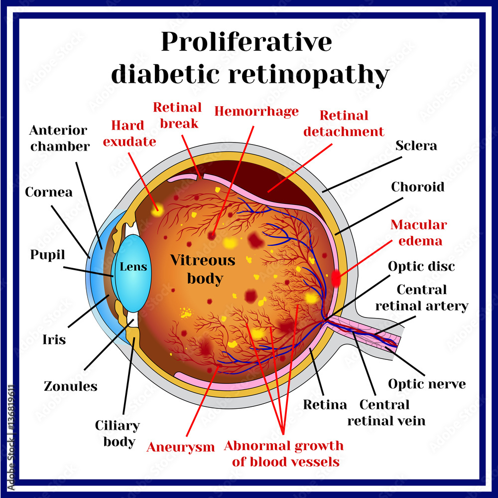 Types of diabetic retinopathy: proliferative retinopathy of retina ...