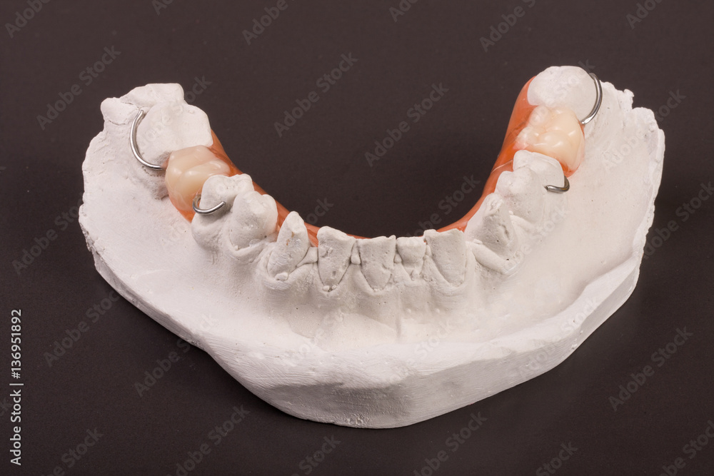 plaster cast of teeth with removable partial denture on a dark ...