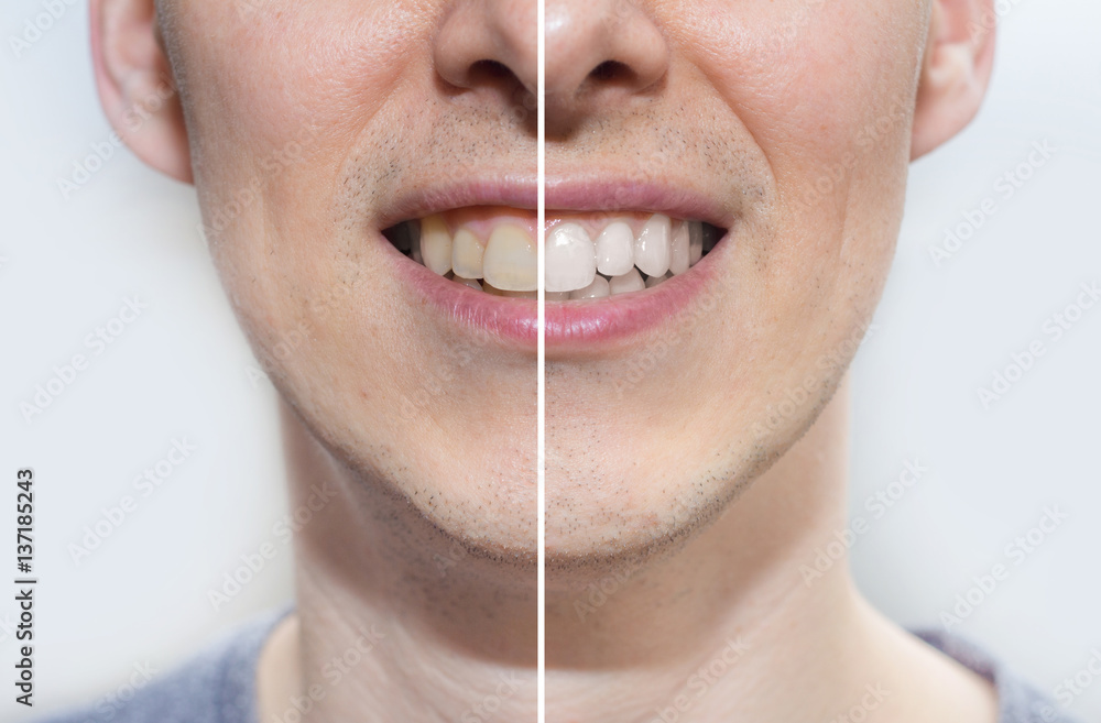 teeth before and after Stock Photo | Adobe Stock