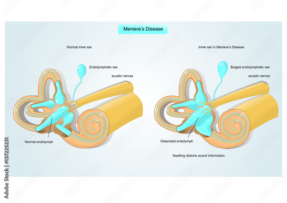 meniere's disease: disorder of the inner ear Stock Vector | Adobe Stock