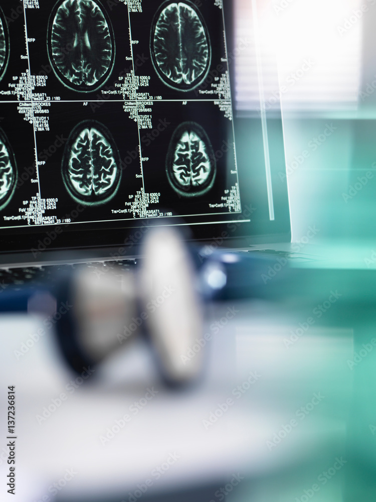 Series of MRI brain scans on computer screen with stethoscope in ...
