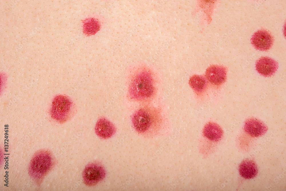 Poster chickenpox rash on the body – Wall Art | UkPosters