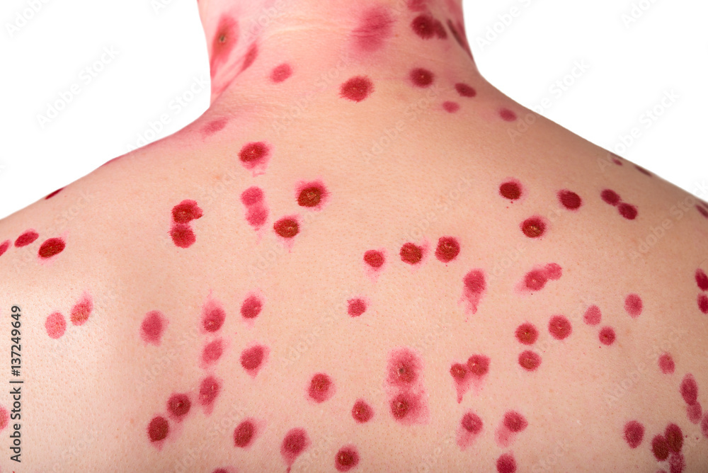 rash on the back Stock Photo | Adobe Stock