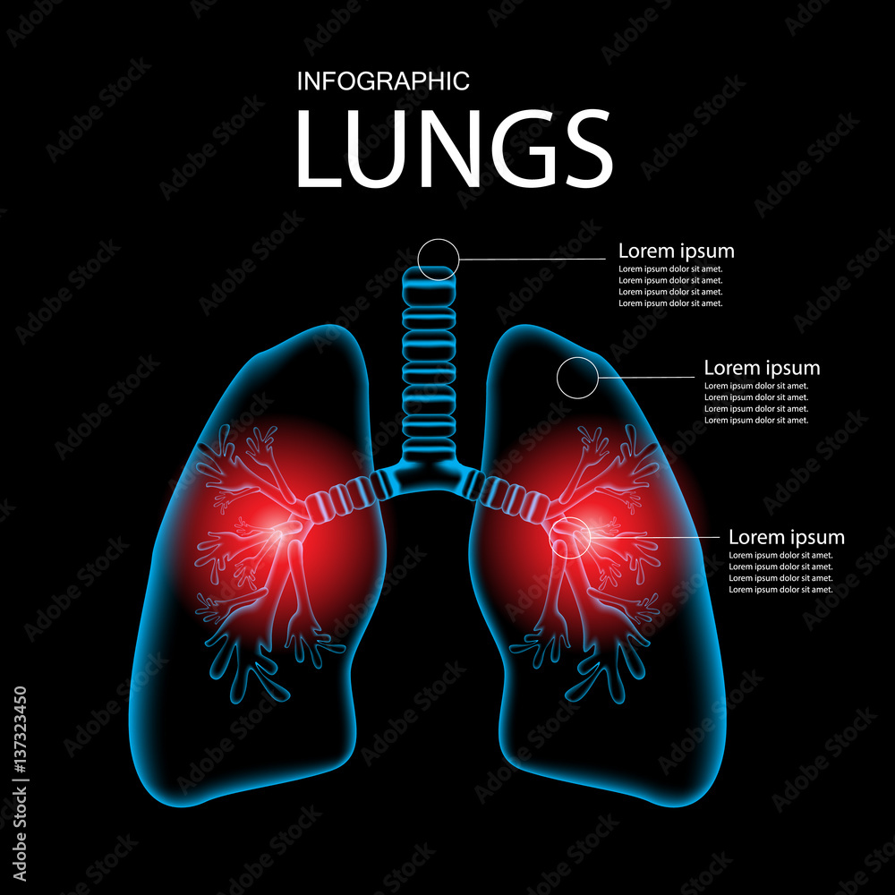 Lungs pain, Lungs x ray Stock Illustration | Adobe Stock