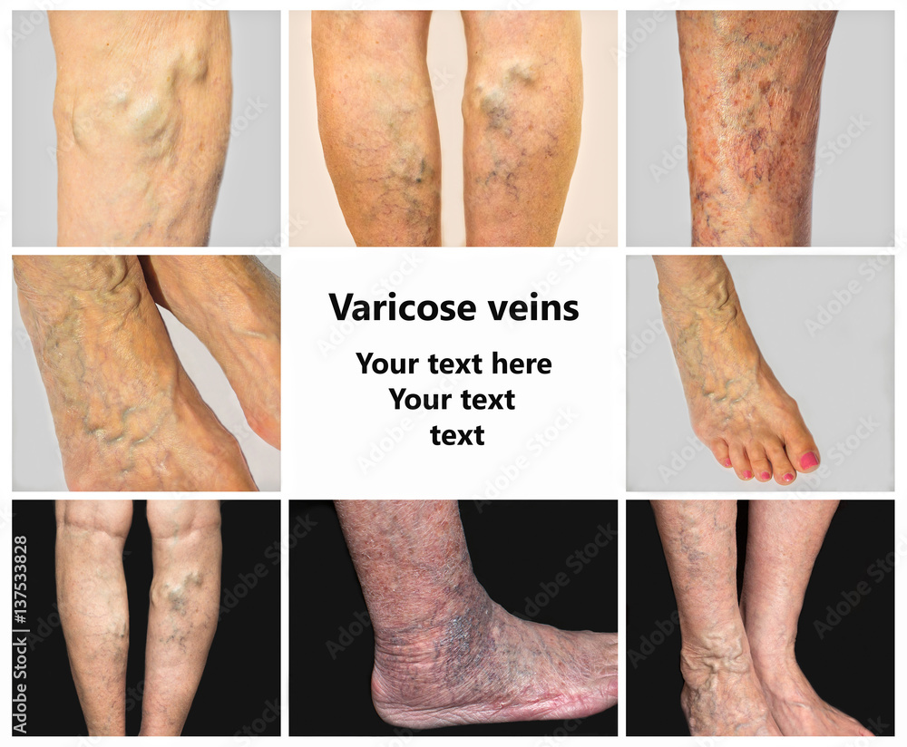 Collage from images of varicose veins Stock Photo | Adobe Stock