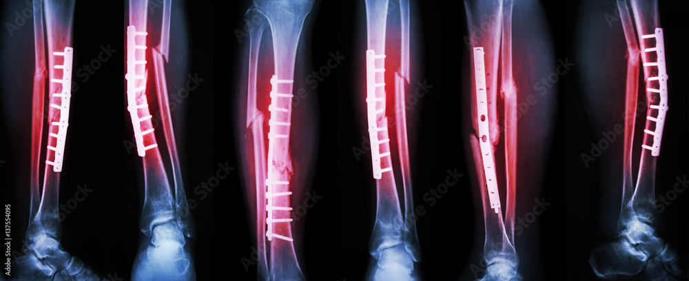 Collection image of leg fracture and surgical treatment by internal ...