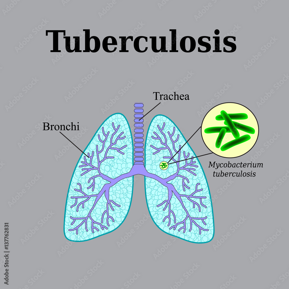 Tubercle Lung