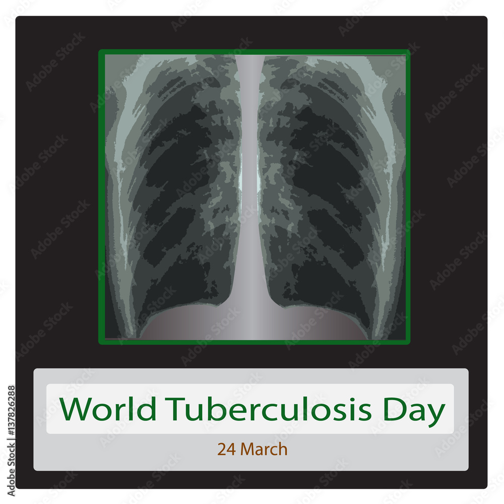 X-rays of light. Diagnosis of tuberculosis. Vector illustration on ...