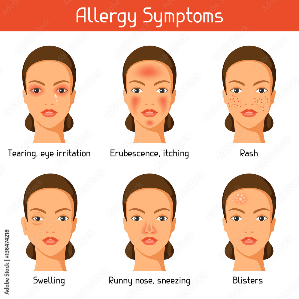 Allergy symptoms. Vector illustration for medical websites advertising ...