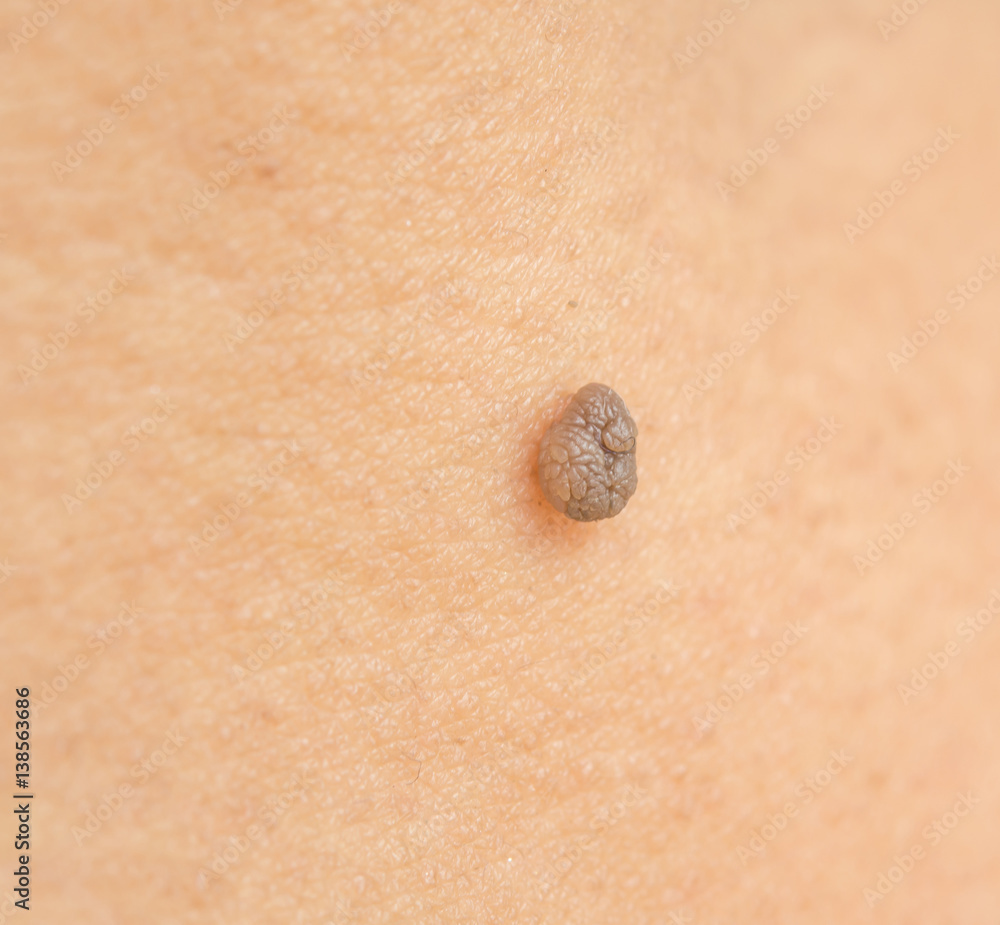 A lump on the skin Stock Photo | Adobe Stock