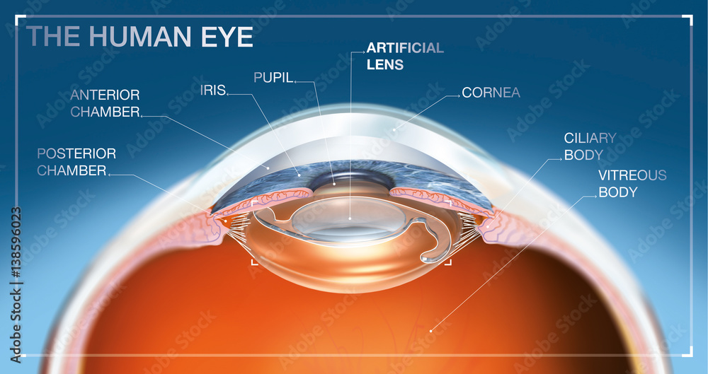 Human eye with artifical lens, medical illustration Stock Illustration ...