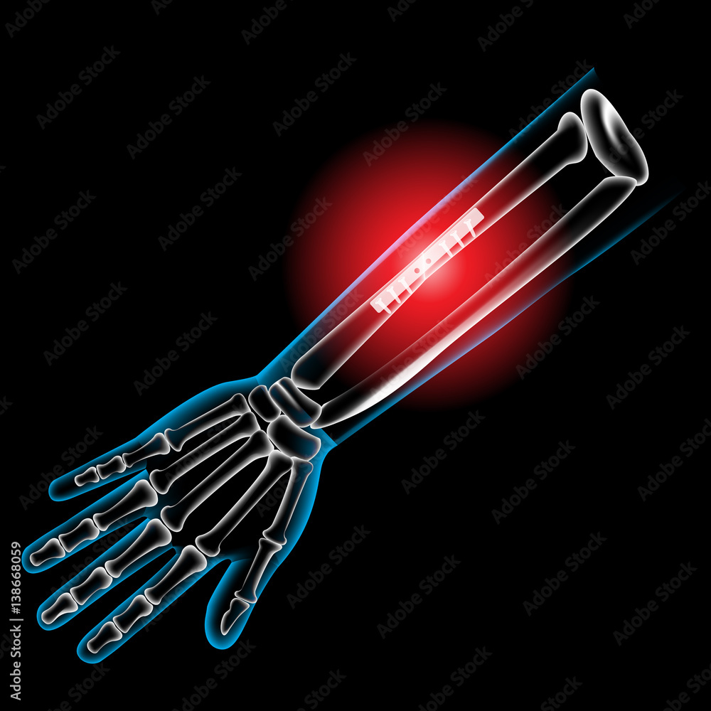 Arm bone and finger bone, pain, x ray, broken arm, Pins and screws to ...