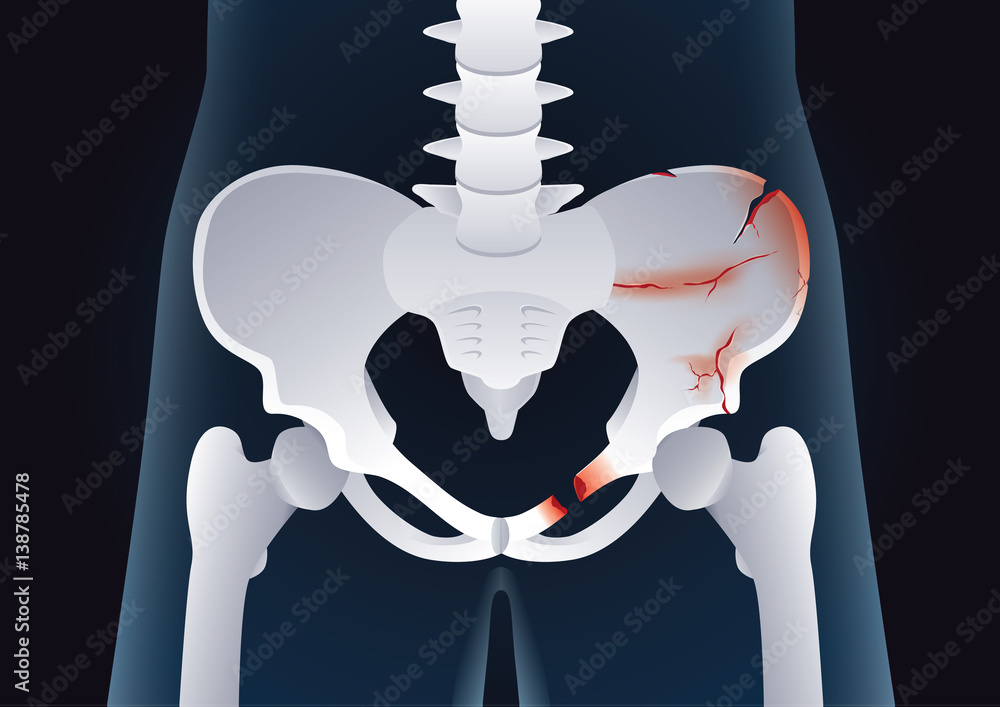 Fractures of the pelvic. Illustration about body injury. Stock Vector ...