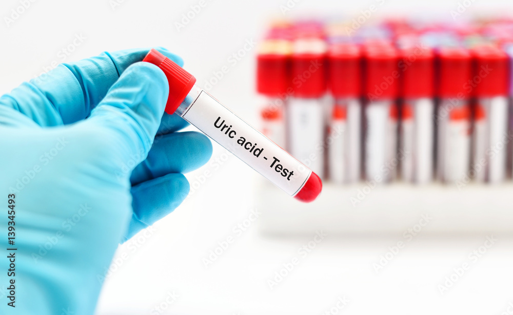 Blood sample for uric acid test, gouty arthritis diagnosis Stock Photo ...