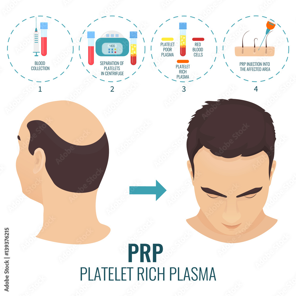 Male hair loss treatment with platelet rich plasma injection. Stages of ...