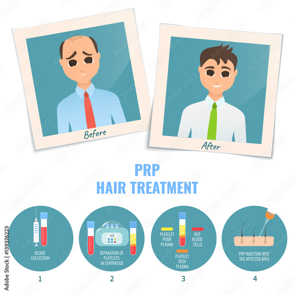 Photographs of a man before and after PRP treatment. Platelet rich ...