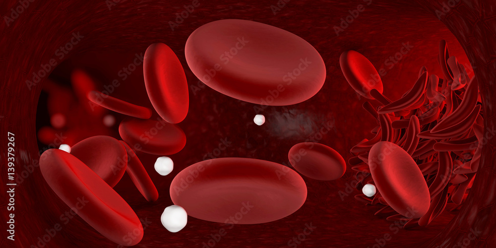 Blood vessel with normal and deformed crescent red blood cells, 3D ...