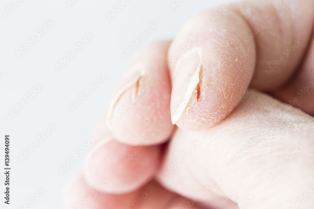 horizontal image of a caucasian woman's hand that are cracked and dry ...
