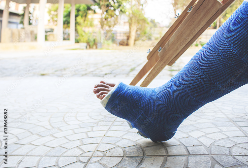 broken leg in a plaster cast with soft-focus in the background. over ...