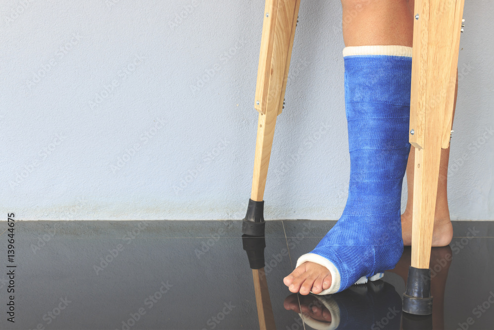broken leg in a plaster cast with soft-focus in the background. over ...