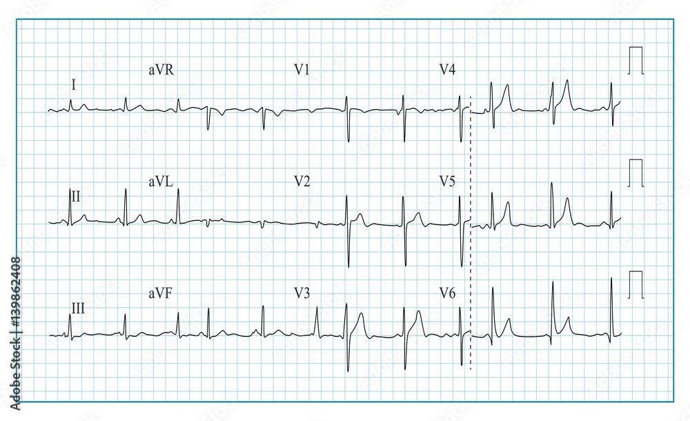 Heart Cardiogram Chart Vector. Illustration Of Wave Form On Checked Ecg ...