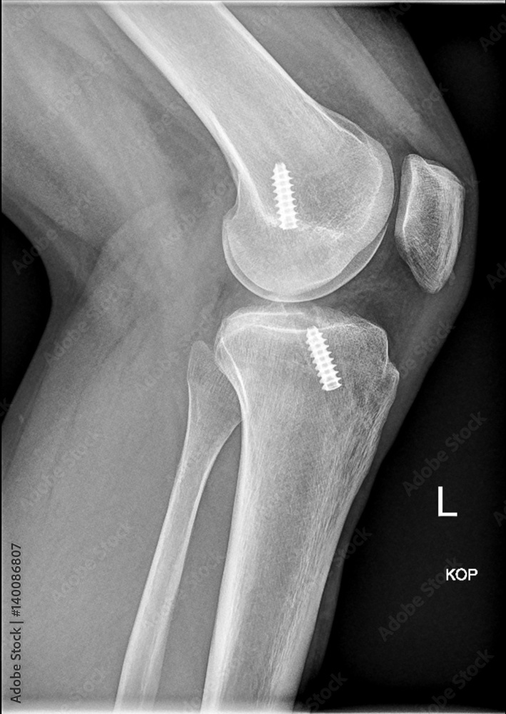Femoral interference screw, Anatomical reconstruction of anterior ...