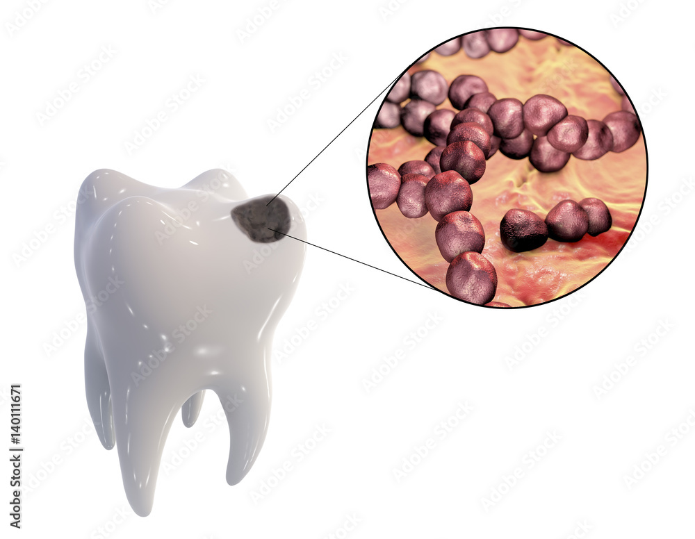 Tooth with dental caries and close-up view of microbes which cause ...