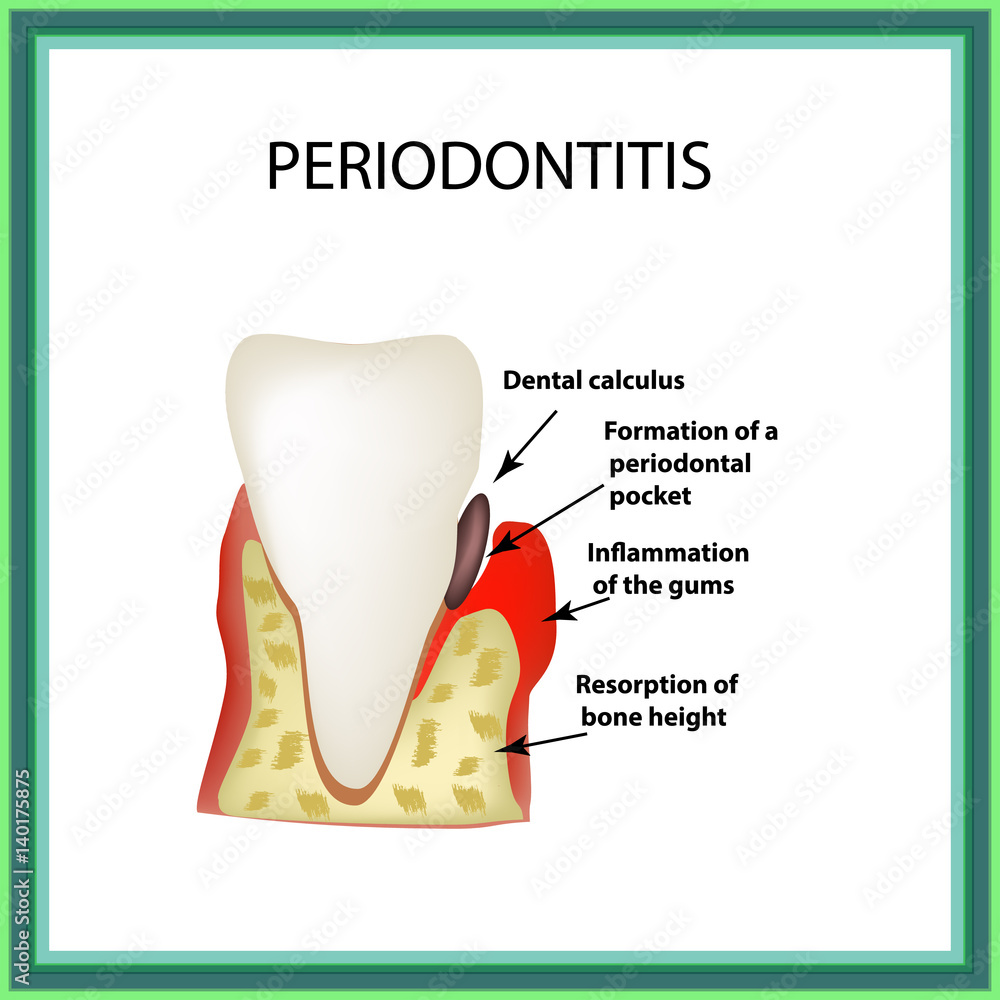 Periodontitis. dental disease. Inflammation of the gums and the tooth ...