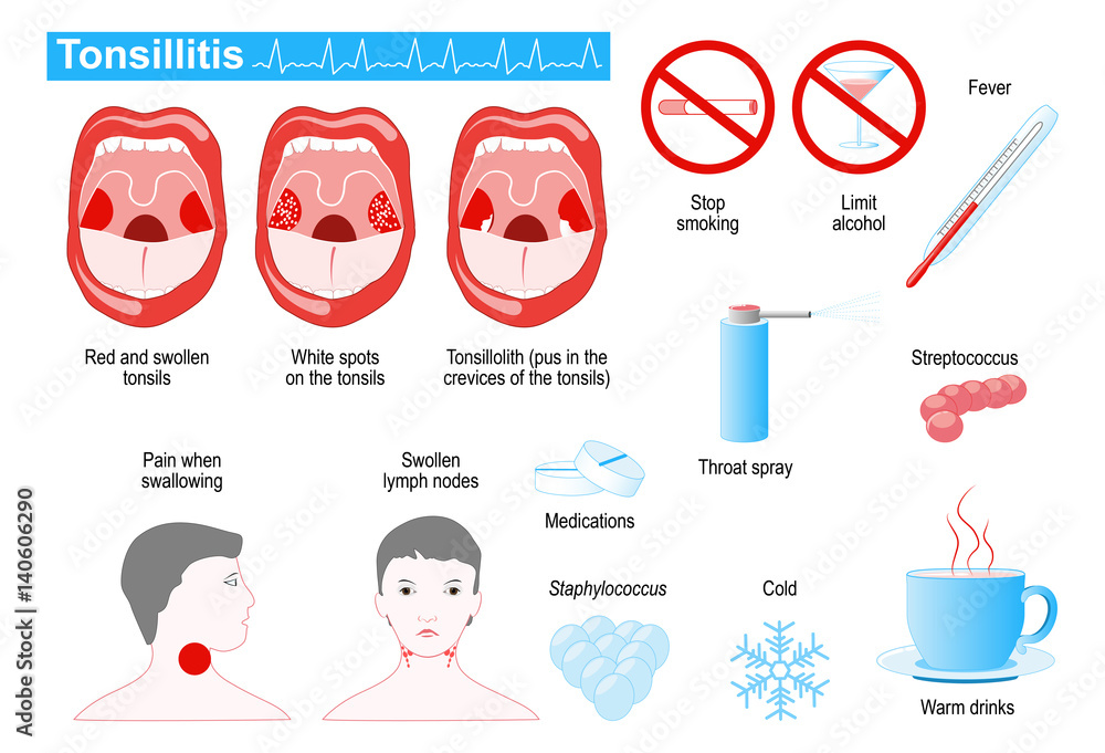 tonsillitis infographic Stock Vector | Adobe Stock