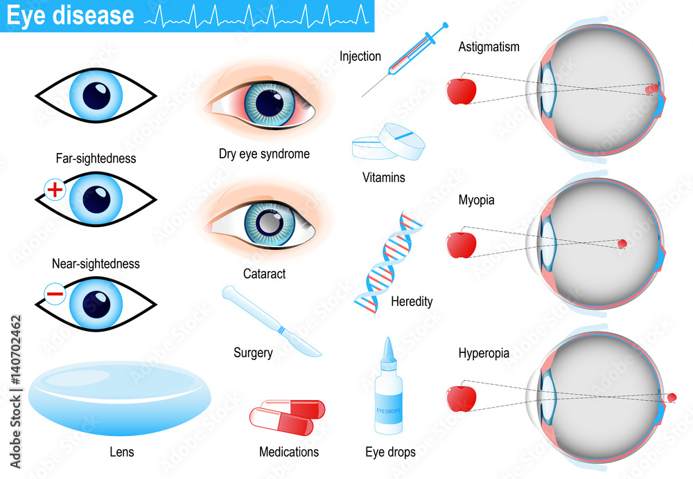 human eye diseases and disorders. Infographic Stock Vector | Adobe Stock