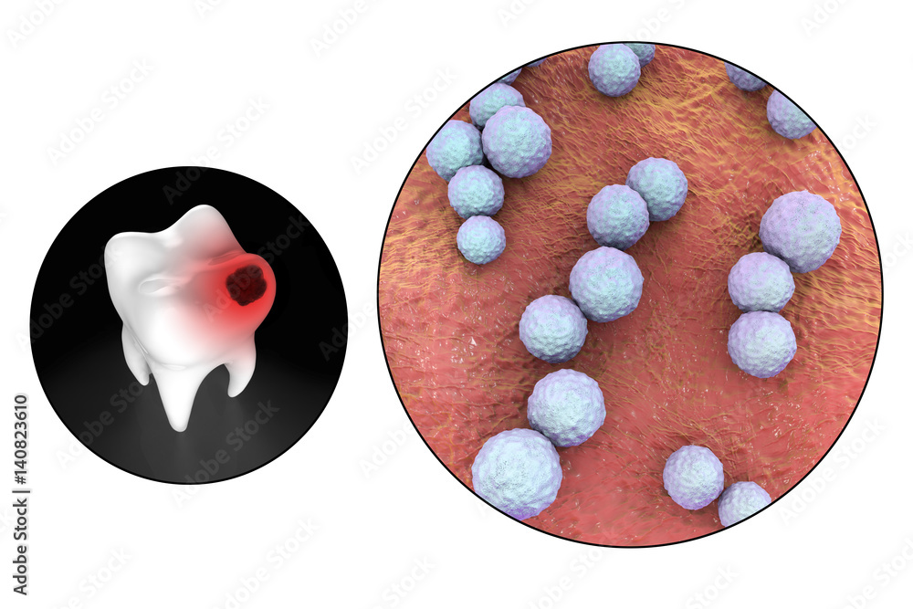 Tooth with decay, dental caries and close-up view of microbes which ...