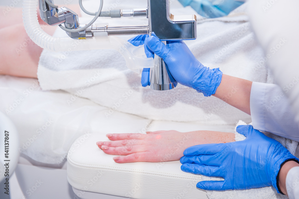 Close up process of laser peeling of the female hand. Laser ...