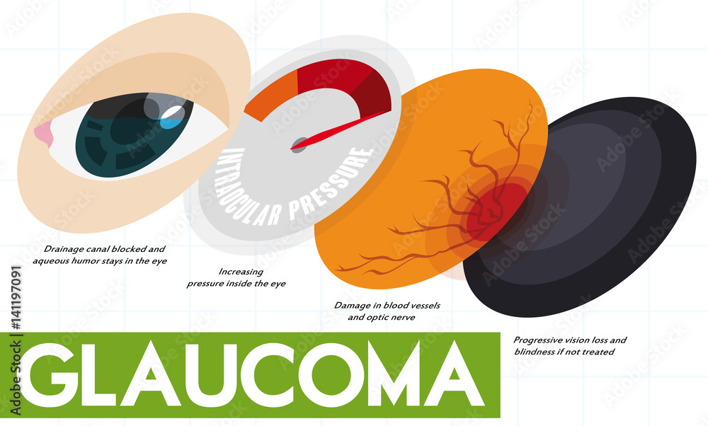 Descriptive Infographic Showing Some Stages of Glaucoma Disease, Vector ...