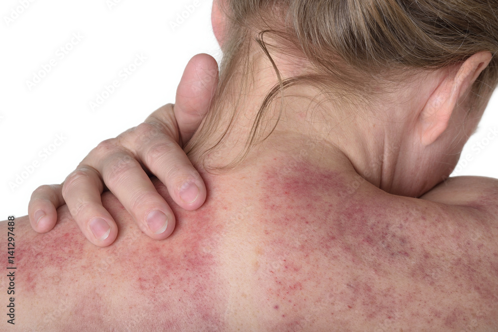 Rücken nach Gua sha Behandlung Stock-Foto | Adobe Stock