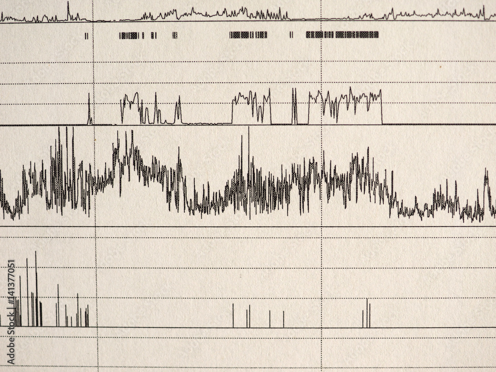 polysomnography (PSG) sleep study Stock Photo | Adobe Stock