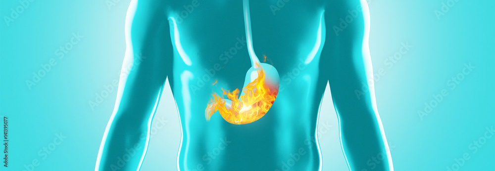 Stomaco infiammato, indigestione o reflusso Stock-Illustration | Adobe ...