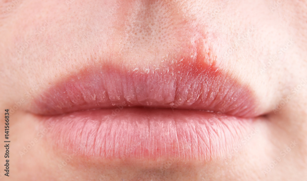 Herpes blisters on female lips closeup Stock Photo | Adobe Stock