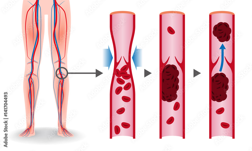 Economy class syndrome mechanism, deep vein thrombosis(DVT), Pulmonary ...